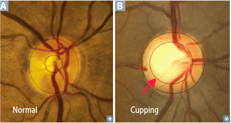Optic Disc Normal Illustrations