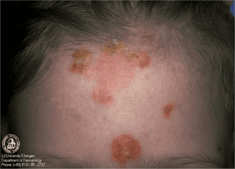 Ecthyma Impetigo
