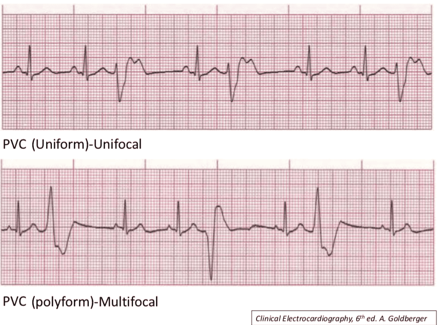 Unifocal Vs Multifocal Pvc – ECG tutorial: Ventricular arrhythmias – JAENEA